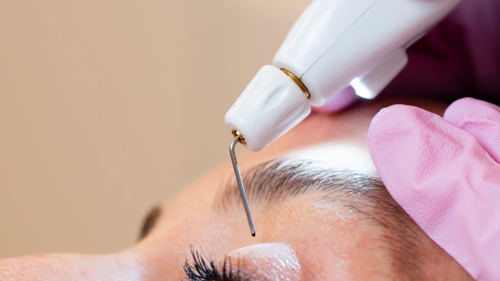 Plasma Pen: Innovación en Rejuvenecimiento Facial